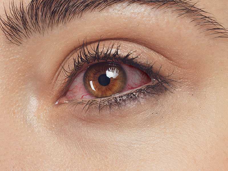 Penyebab Mata Merah Saat Menggunakan Lensa Kontak